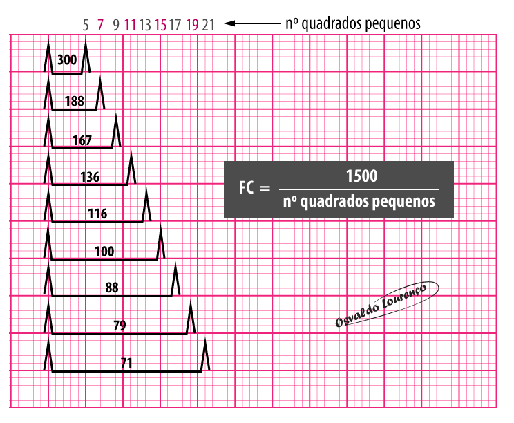 Frequ ncia Card aca E Amplitude Como Determinar No ECG ANGOMED NEWS Frequ ncia Card aca E Amplitude Como Determinar No ECG ANGOMED NEWS
